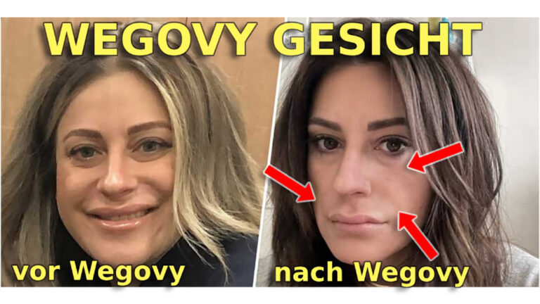 Wegovy Gesicht – was es ist und wie Du es vermeiden kannst